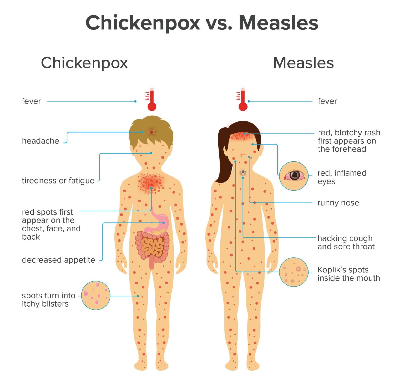 Is it Measles or Chickenpox? Causes, Symptoms, and Treatment
